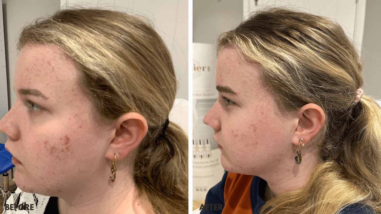 SkinPen Microneedling | Guildford, Surrey | Optimise Aesthetics