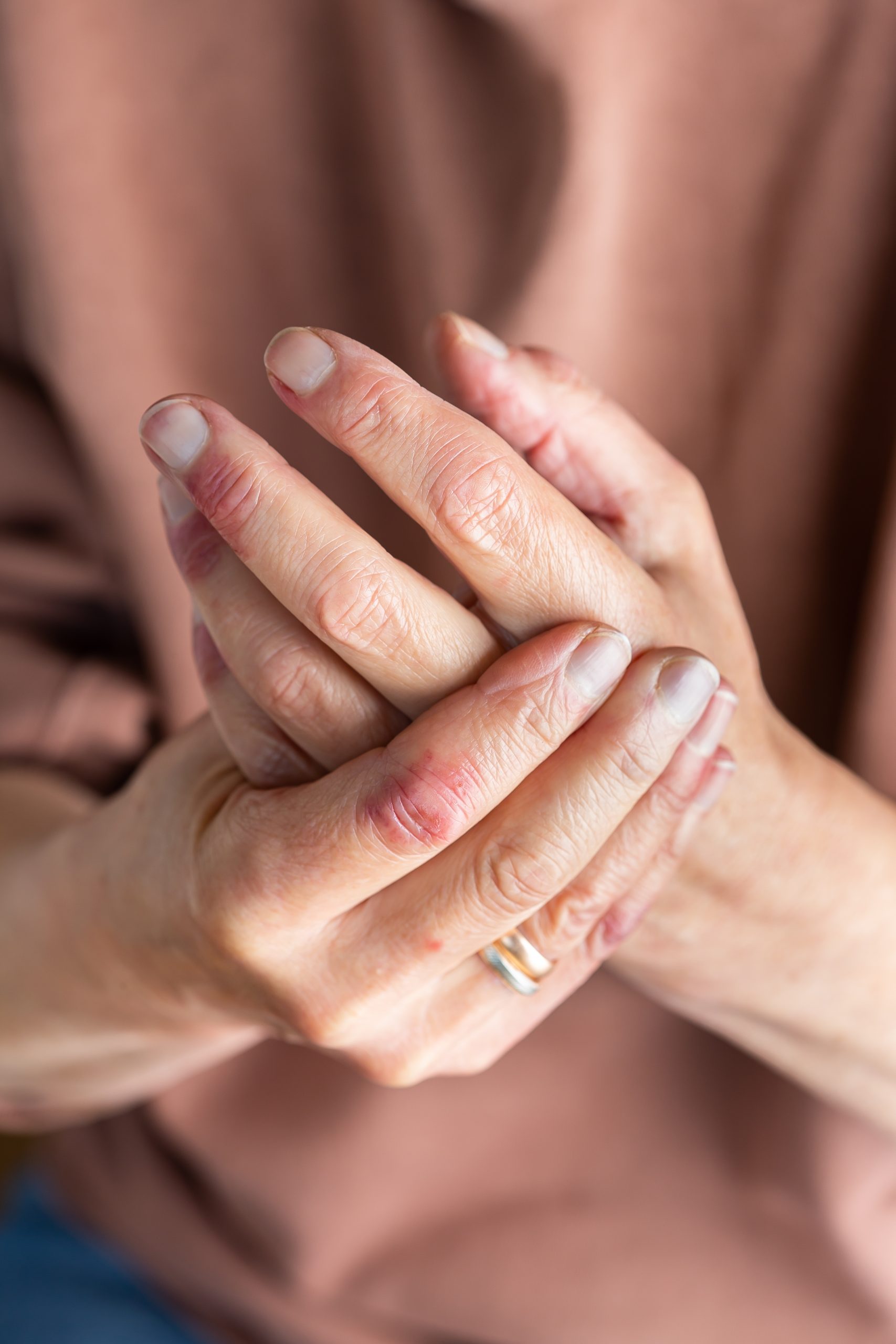 Ageing Hands | Skin Conditions | Optimise Aesthetics in Guildford